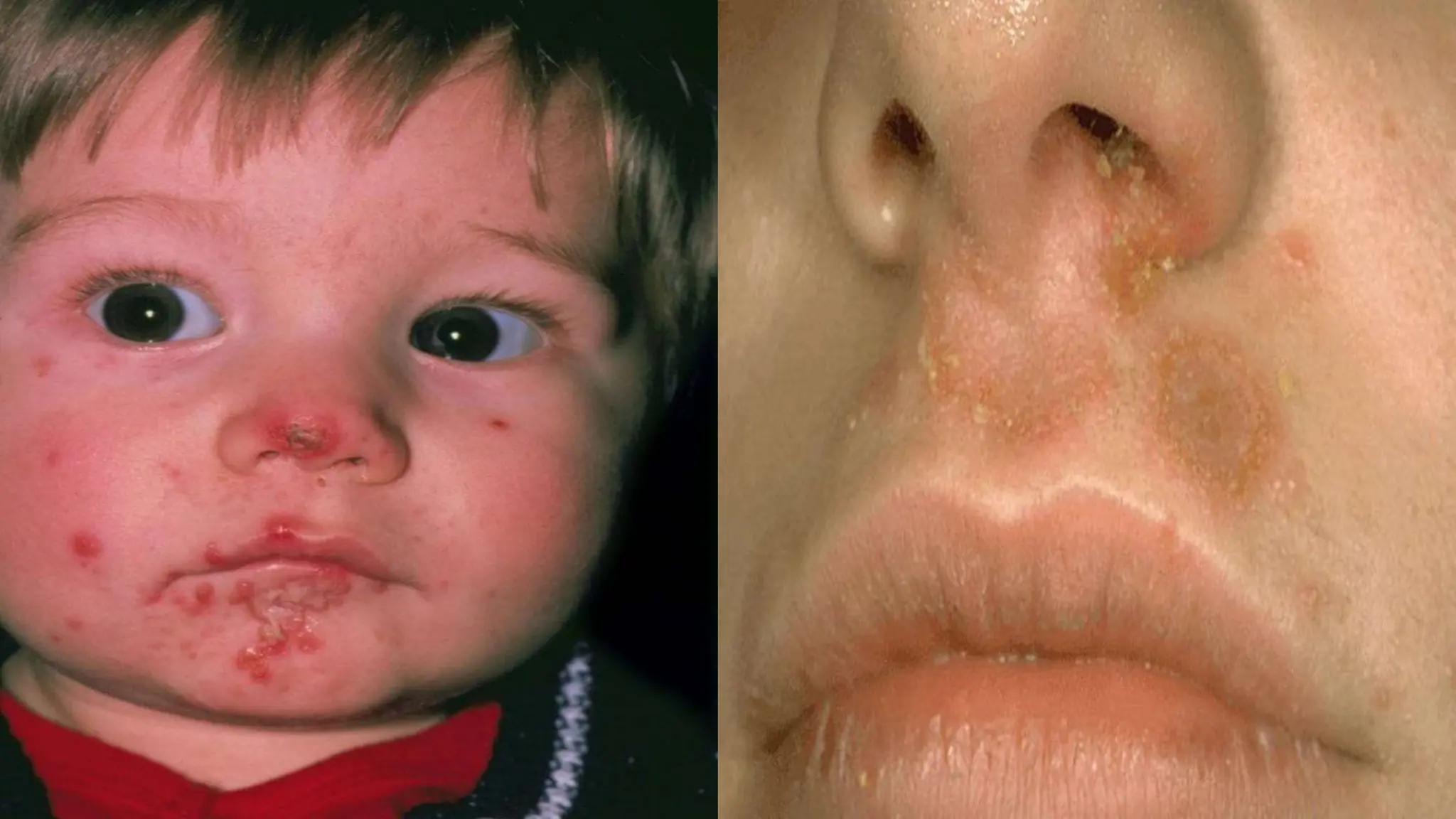 infection cutanées recommandations 2023p | PPT