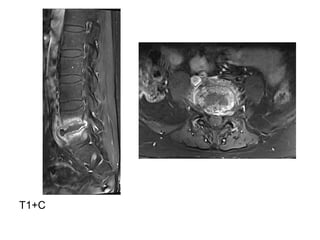 Diagnostic Imaging of Spinal Infection & Inflammation | PPT
