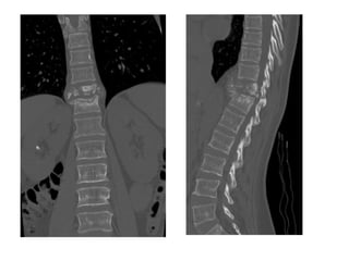 Diagnostic Imaging of Spinal Infection & Inflammation | PPT