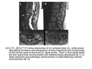 Diagnostic Imaging of Spinal Infection & Inflammation | PPT