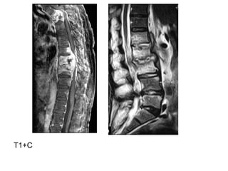 Diagnostic Imaging of Spinal Infection & Inflammation | PPT