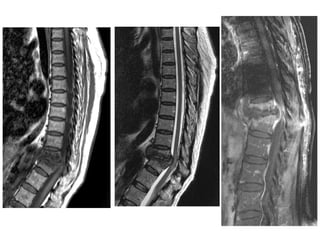 Diagnostic Imaging of Spinal Infection & Inflammation | PPT