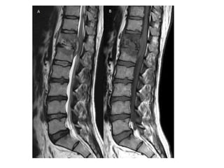Diagnostic Imaging of Spinal Infection & Inflammation | PPT
