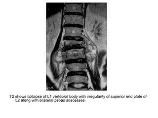 Diagnostic Imaging of Spinal Infection & Inflammation | PPT