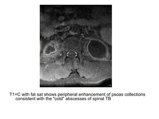 Diagnostic Imaging of Spinal Infection & Inflammation | PPT