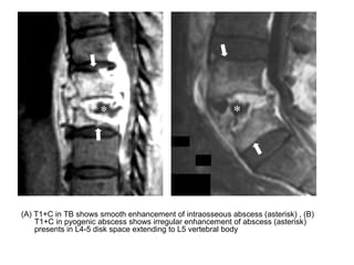 Diagnostic Imaging of Spinal Infection & Inflammation | PPT