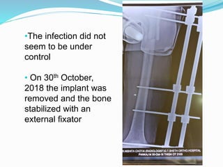 Case senario of Infection in orthopaedics treated with ring fixator | PPT