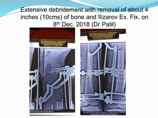 Case senario of Infection in orthopaedics treated with ring fixator | PPT