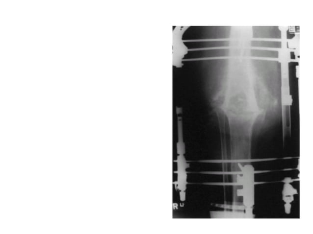 Infection in tkr | PPT | Infectious Diseases | Diseases and Conditions