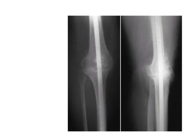 Infection in tkr | PPT | Infectious Diseases | Diseases and Conditions