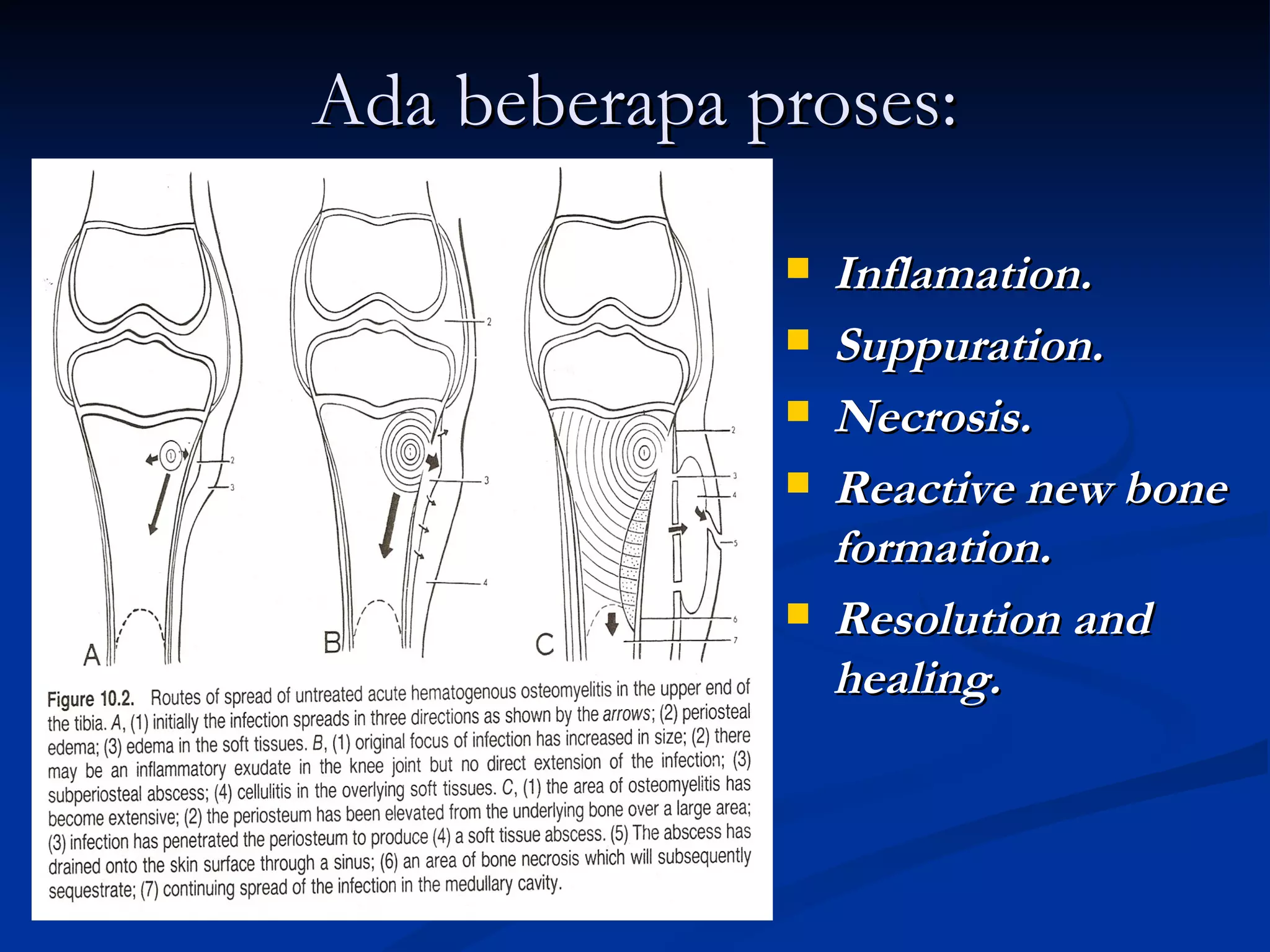 Infection of bone and joint | PPT