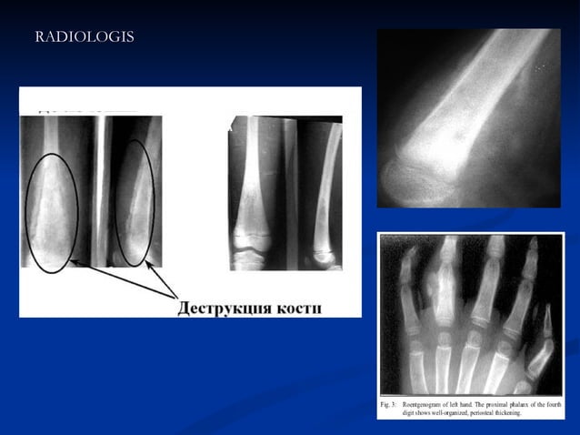 Infection of bone and joint | PPT