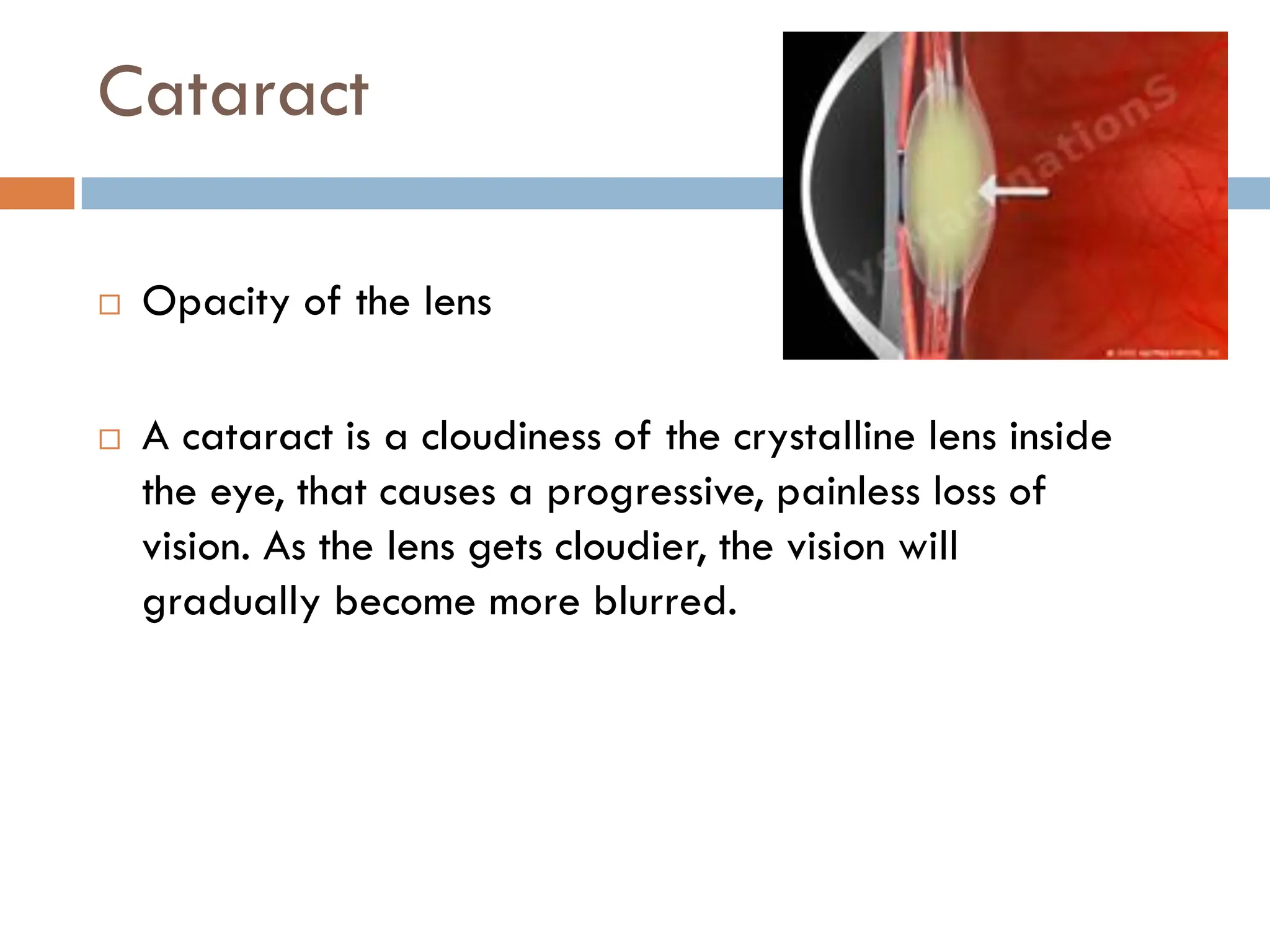 infection of eye and cataract.pdf