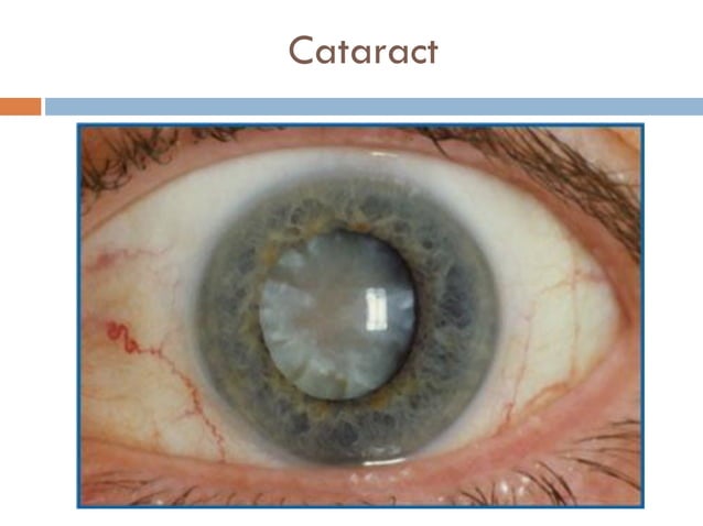 infection of eye and cataract.pdf