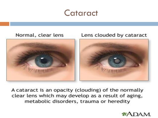 infection of eye and cataract.pdf
