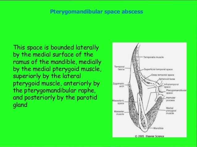 Pterygomandibular Space Infection