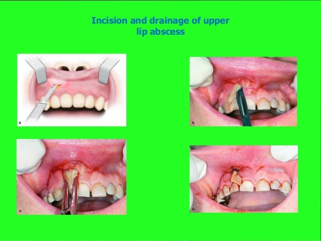 Infection oral paraoral tissues