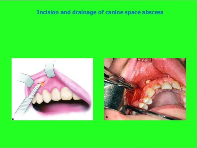 Infection oral paraoral tissues