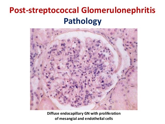 Infection Related Glomerulopathy Introduction Rapid Overview