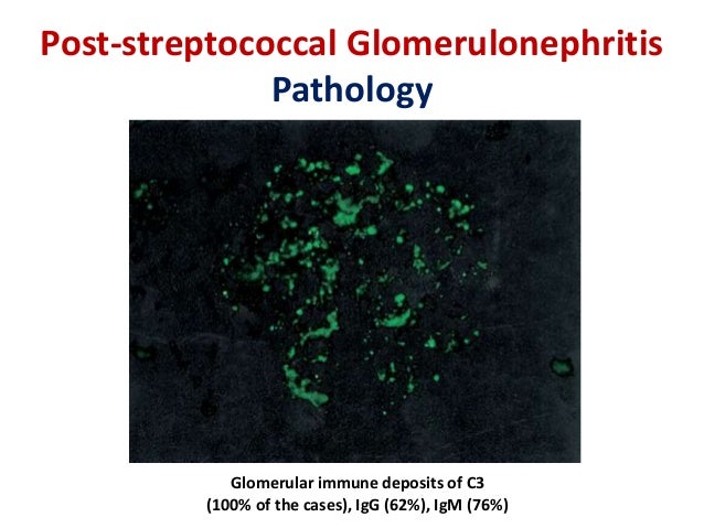 Infection Related Glomerulopathy Introduction Rapid Overview