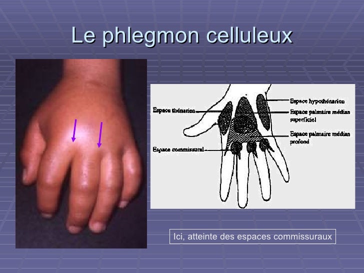 Infections locales en chirurgie