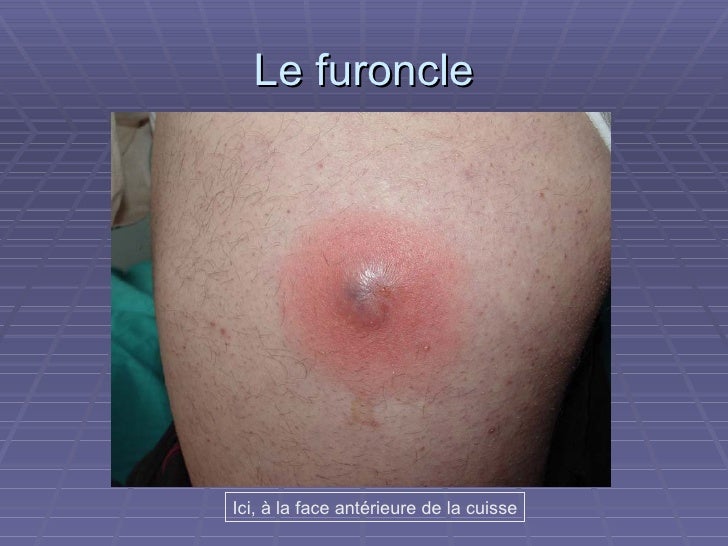 Infections locales en chirurgie