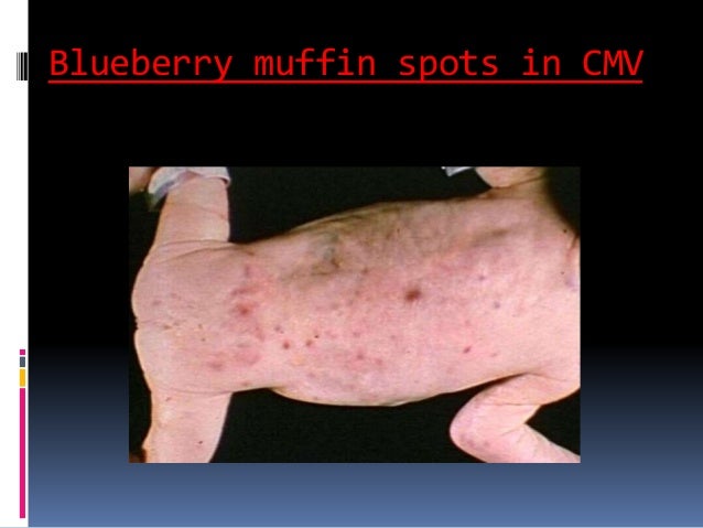 Dermatological Infections in Newborn.. Dr.Padmesh