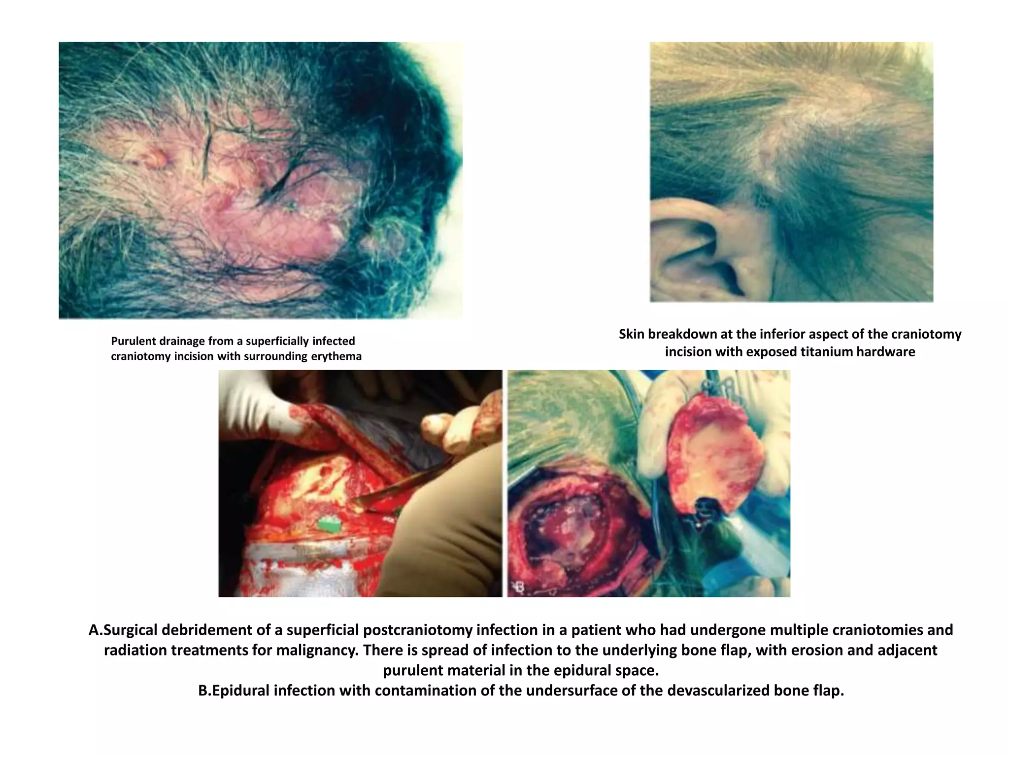Infections in neurosurgery | PPTX