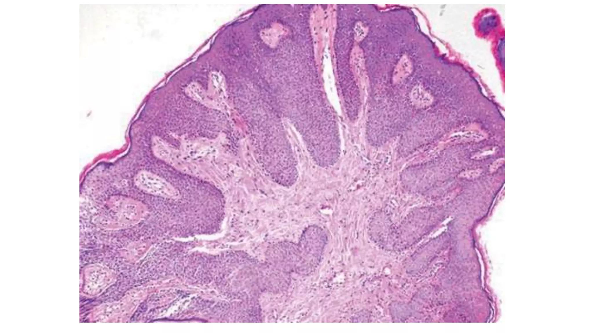 Infections of female genital tract | PPTX