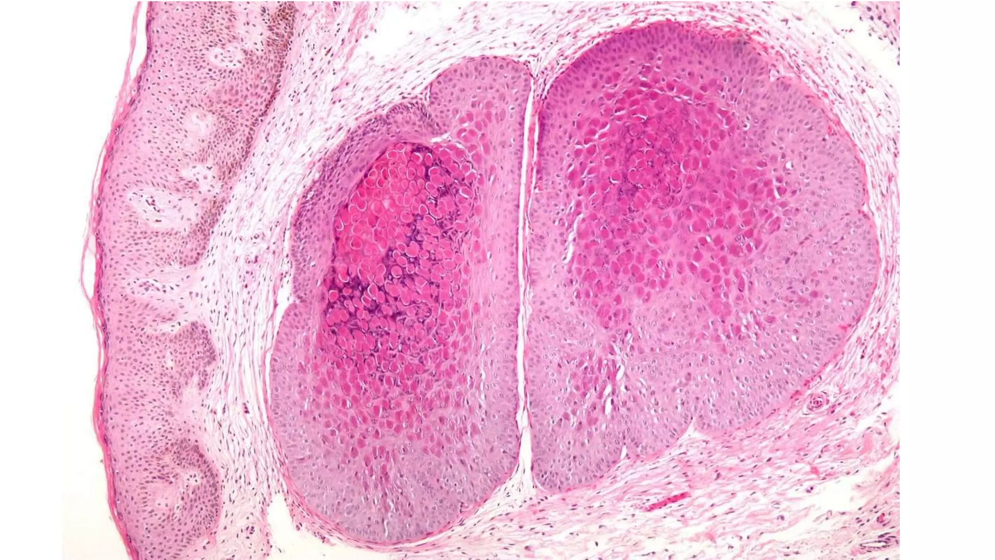Infections of female genital tract | PPTX