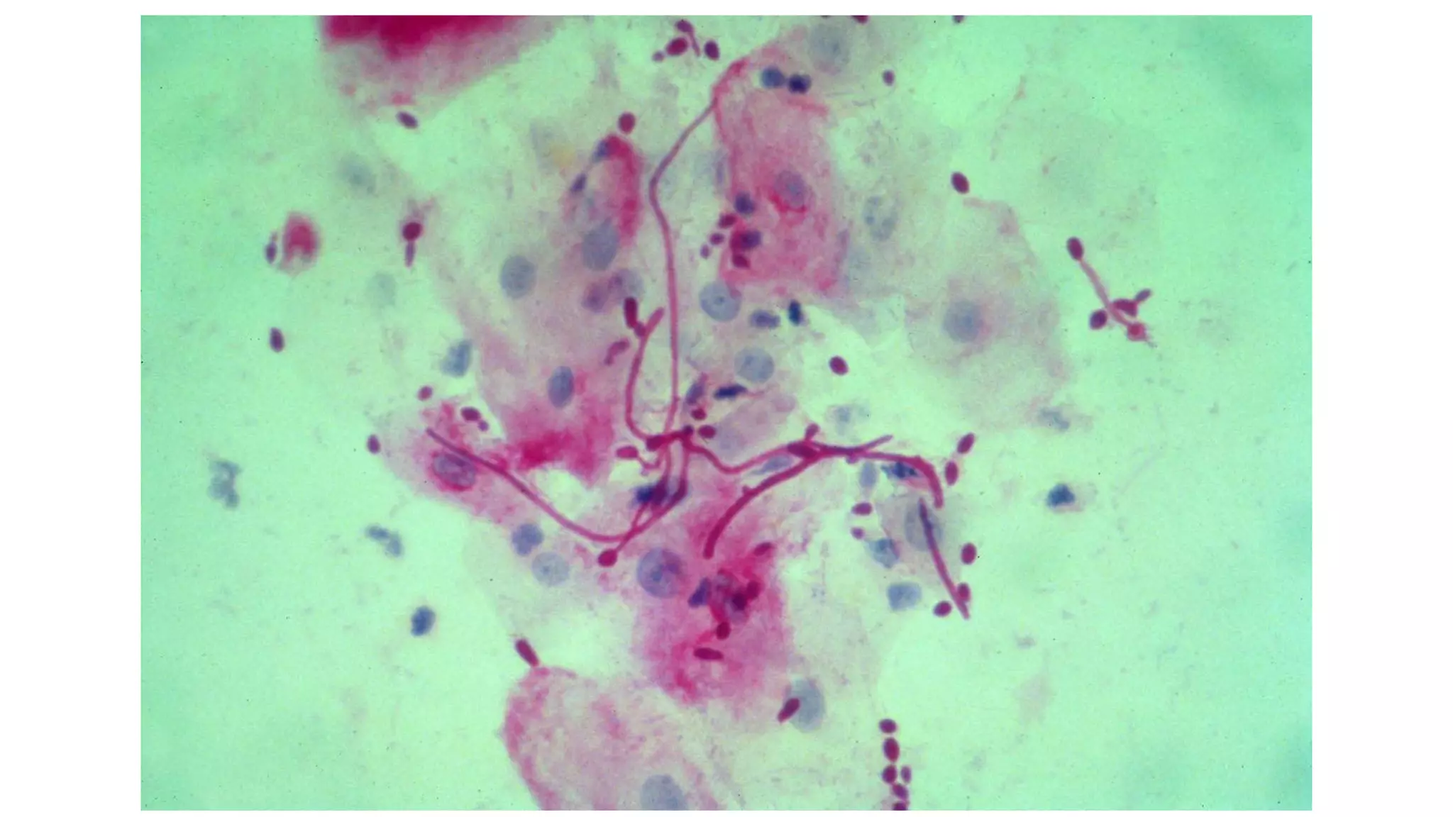 Infections of female genital tract | PPTX