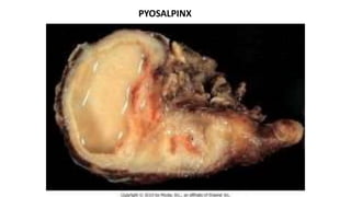 Infections of female genital tract | PPTX