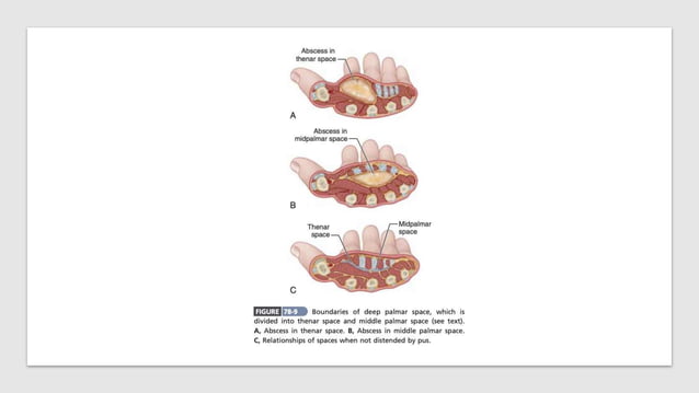 Infections of hand | PPT