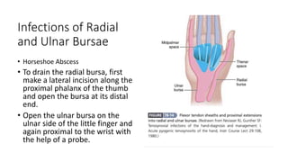 Horseshoe Abscess Hand