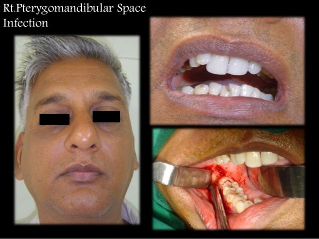 Infections of head and neck