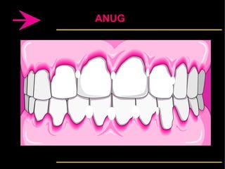 Infections of oral & para-oral tissues | PPT