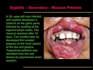Infections of oral & para-oral tissues | PPT