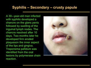 Infections of oral & para-oral tissues | PPT