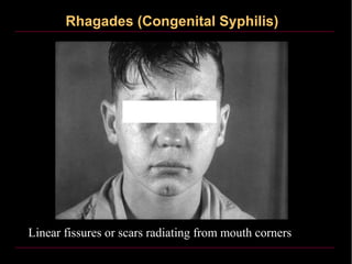 Infections of oral & para-oral tissues | PPT