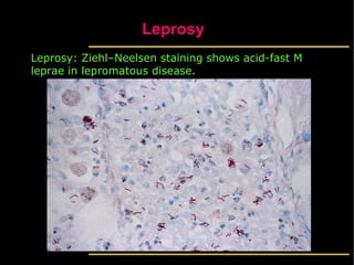 Infections of oral & para-oral tissues | PPT