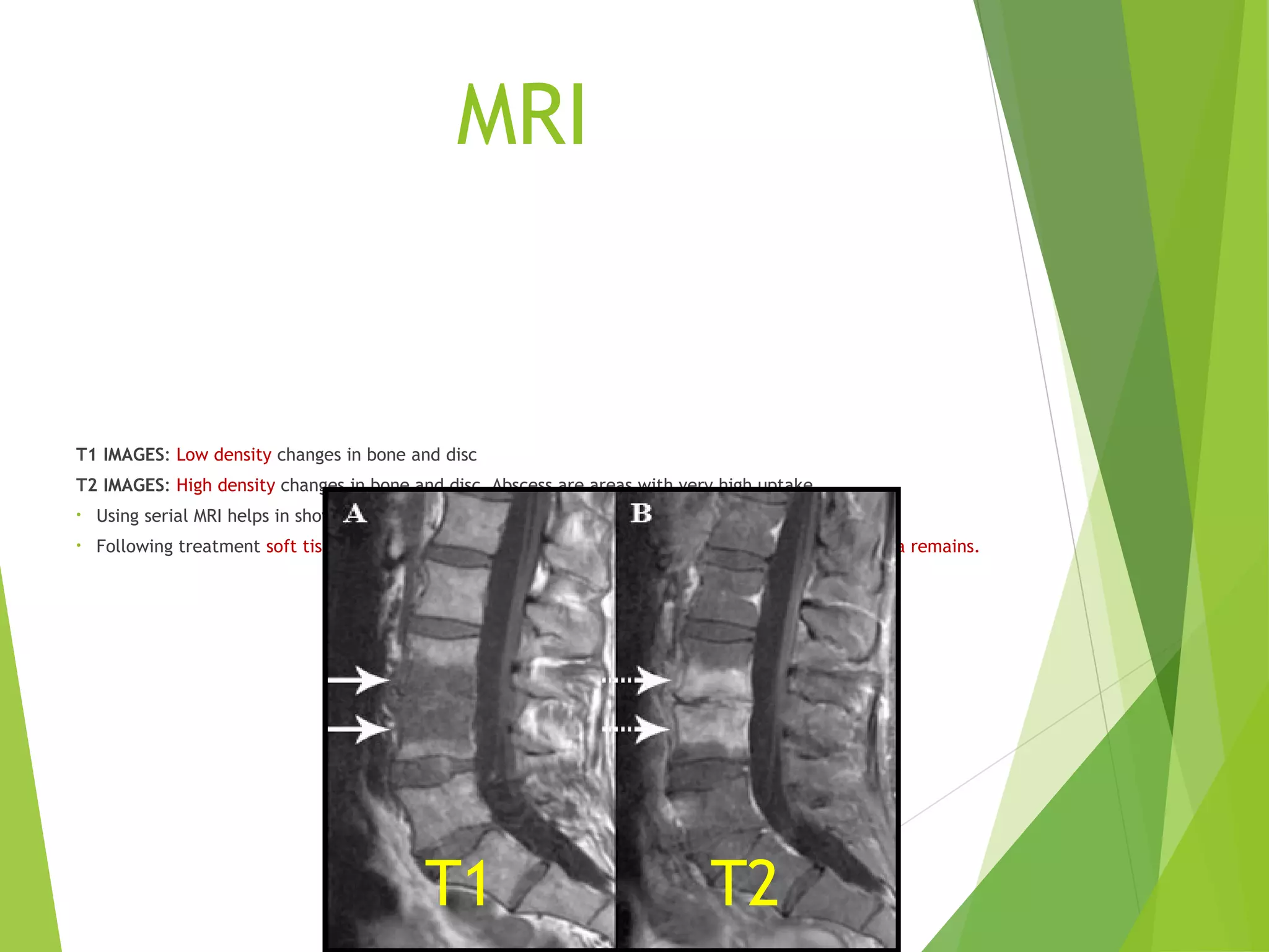 Infections of spine : Pyogenic and tuberculosis | PPT