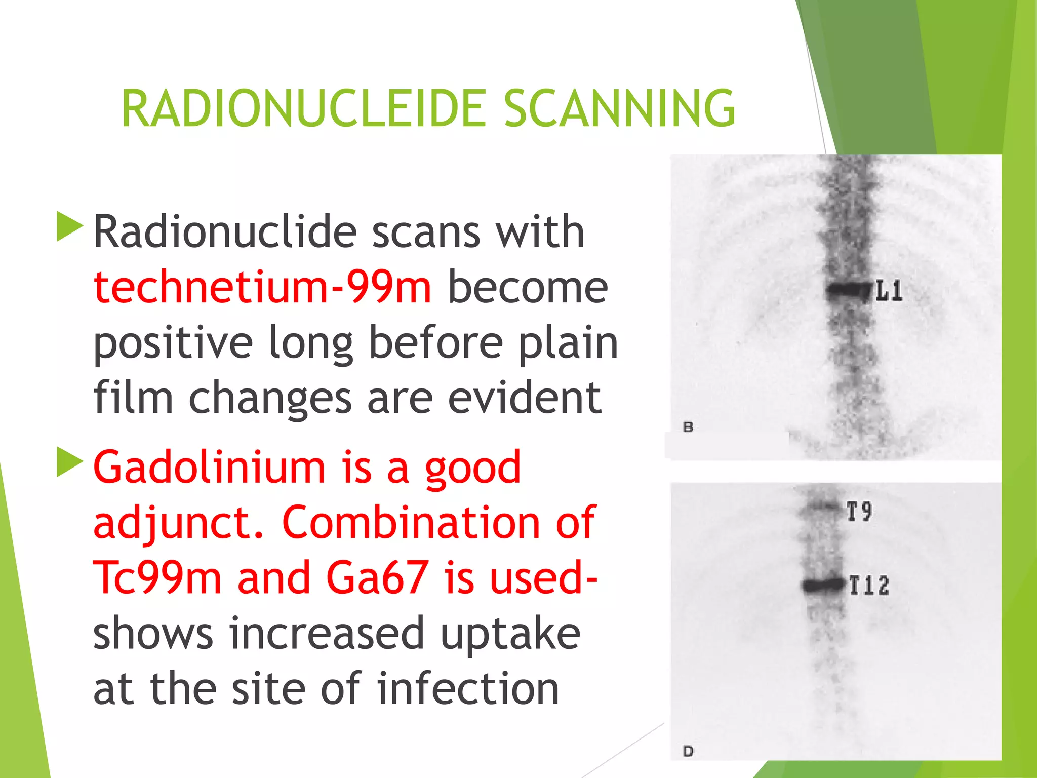 Infections of spine : Pyogenic and tuberculosis | PPT