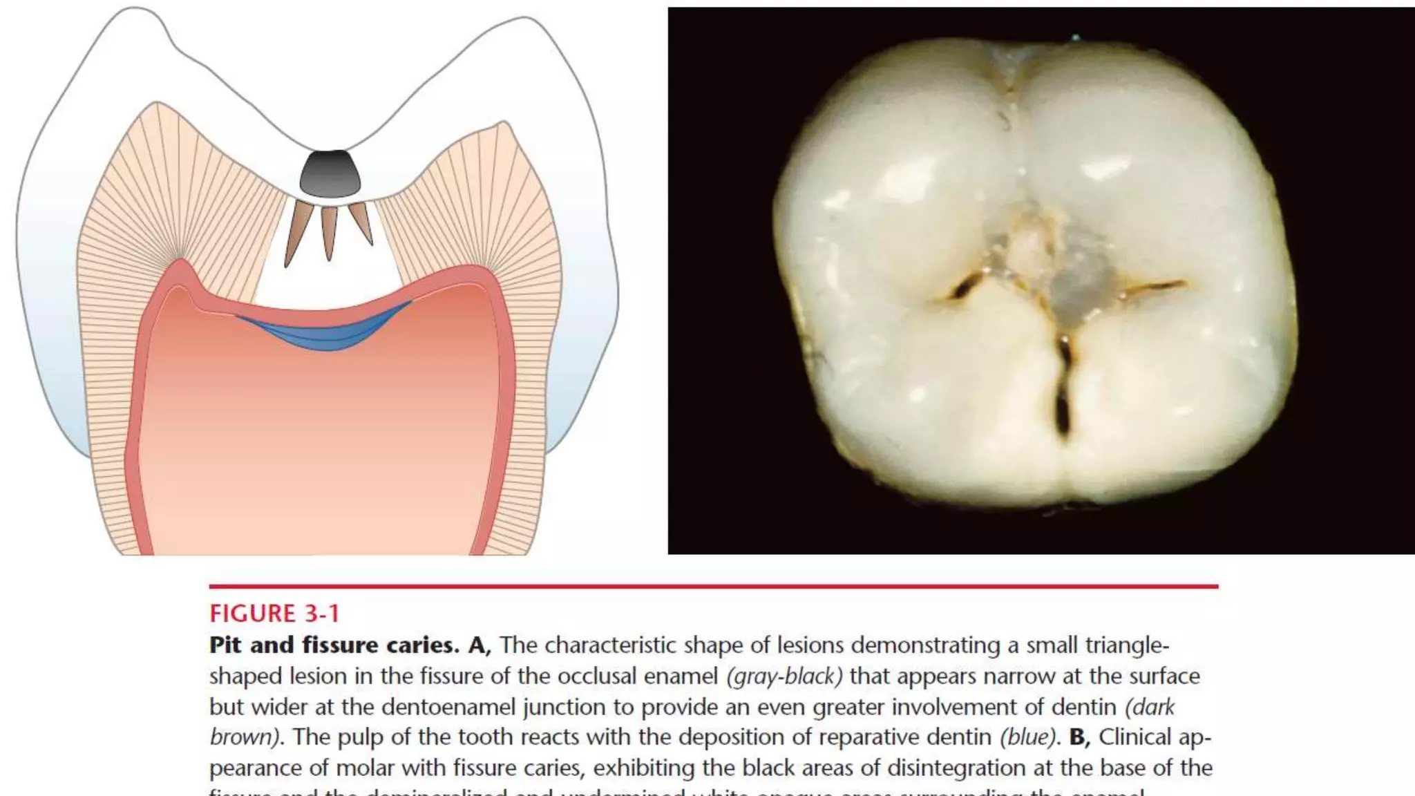 Infections of teeth and bone - Oral Pathology | PPTX