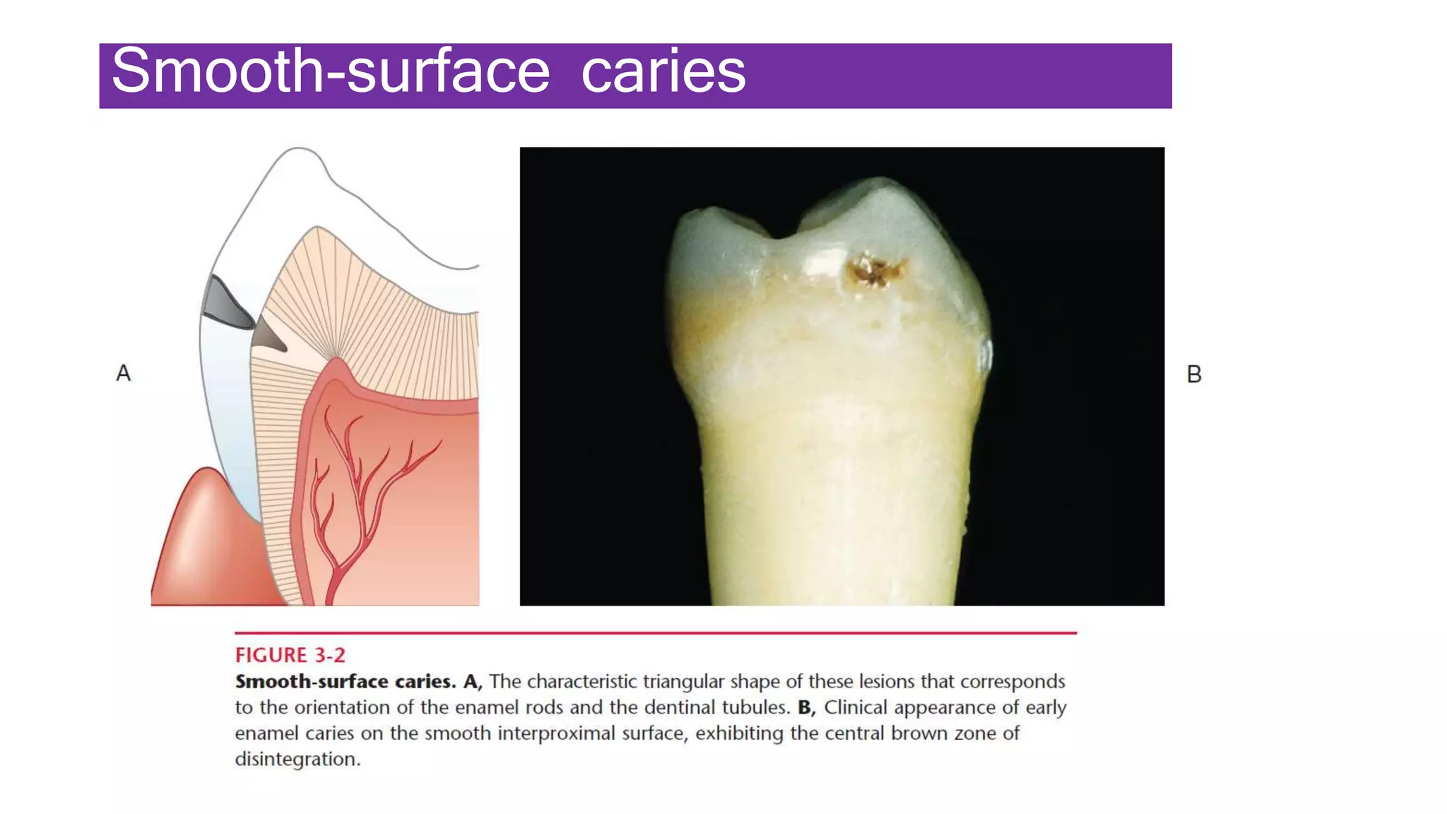 Infections of teeth and bone - Oral Pathology | PPTX