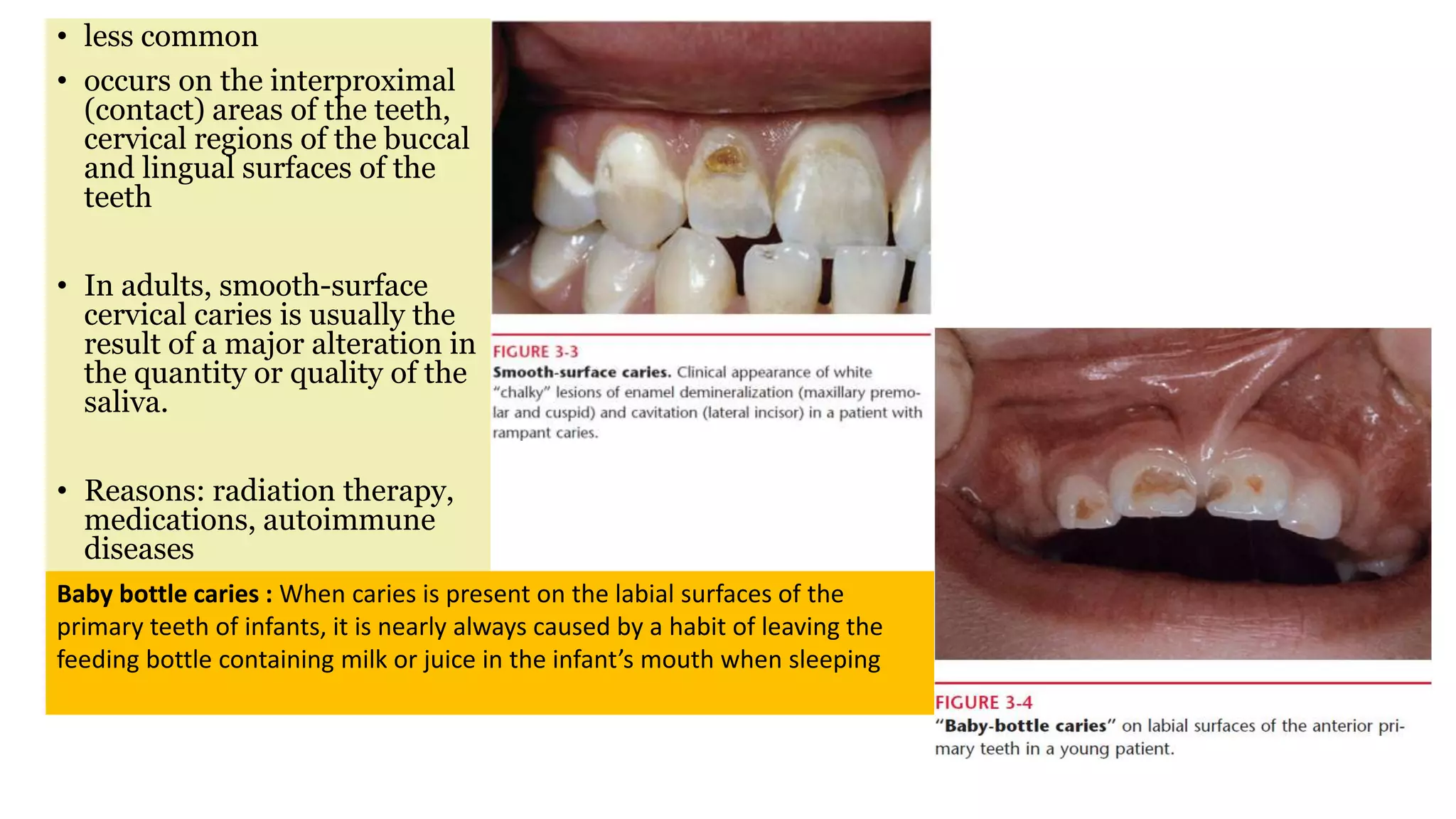 Infections of teeth and bone - Oral Pathology | PPTX