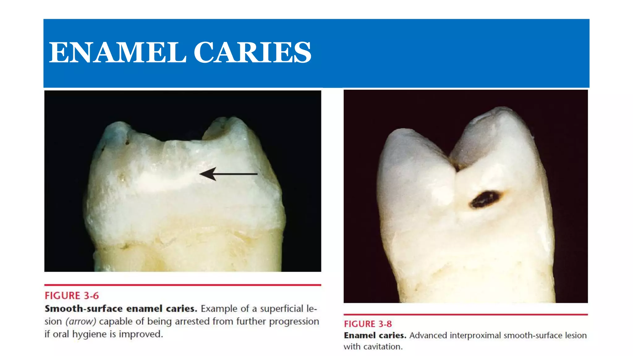 Infections of teeth and bone - Oral Pathology | PPTX
