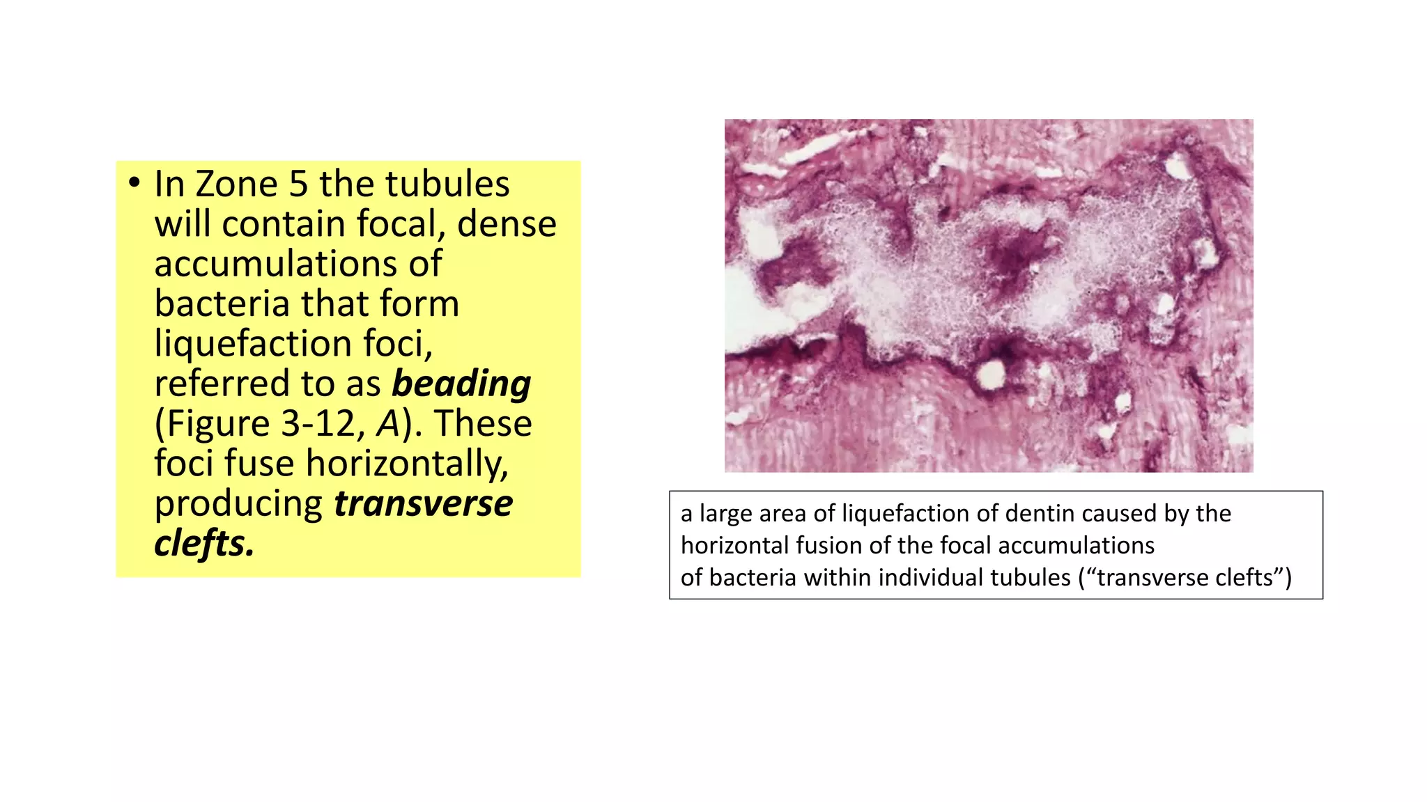 Infections of teeth and bone - Oral Pathology | PPTX