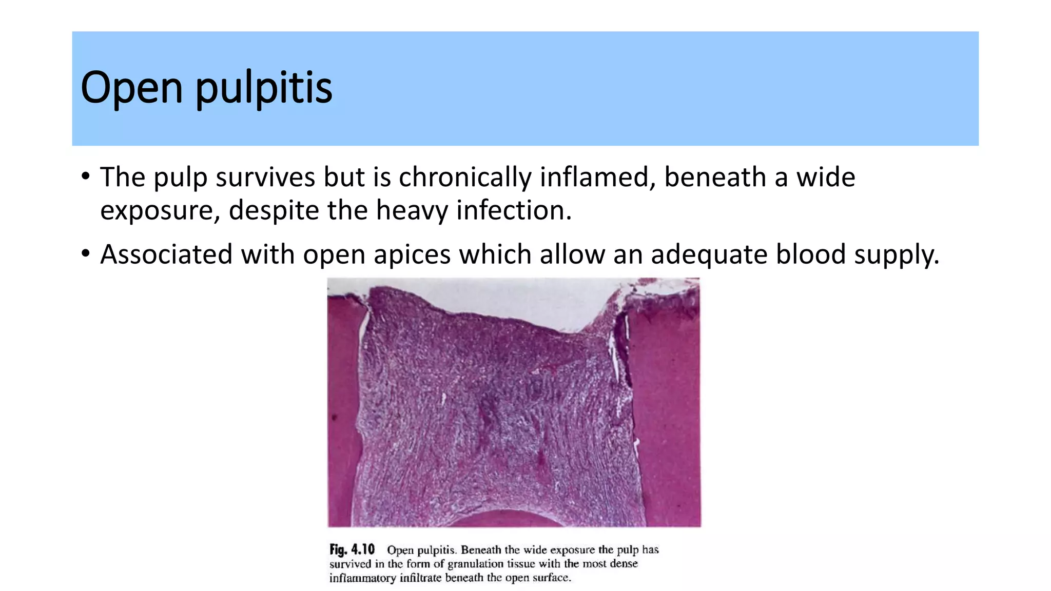 Infections of teeth and bone - Oral Pathology | PPTX