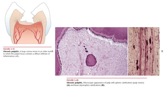 Infections of teeth and bone - Oral Pathology | PPTX