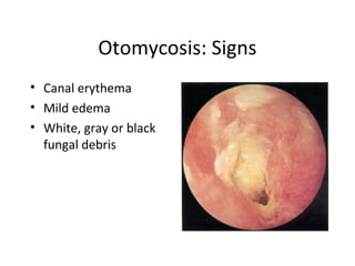 Infections of the external ear
